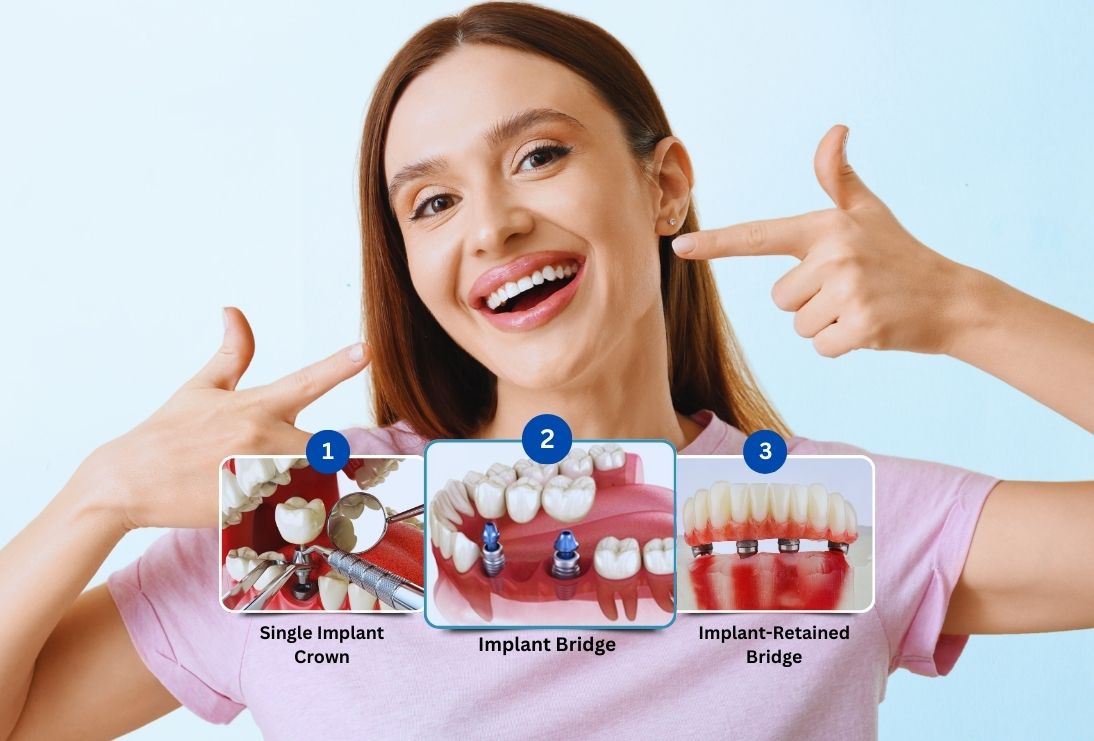 Understanding Dental Implants: A Long-Term Solution for Missing Teeth